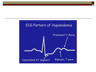 Electrolyte Imbalance and EKG Changes | PPT