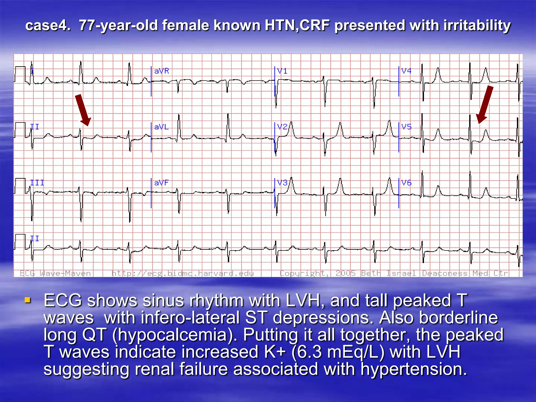 Electrolytes imbalance and ECG changes presentation 2005 | PPTX