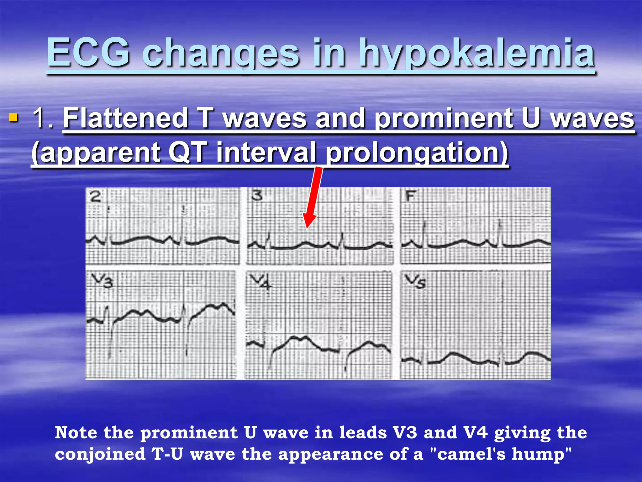 Electrolytes imbalance and ECG changes presentation 2005 | PPTX