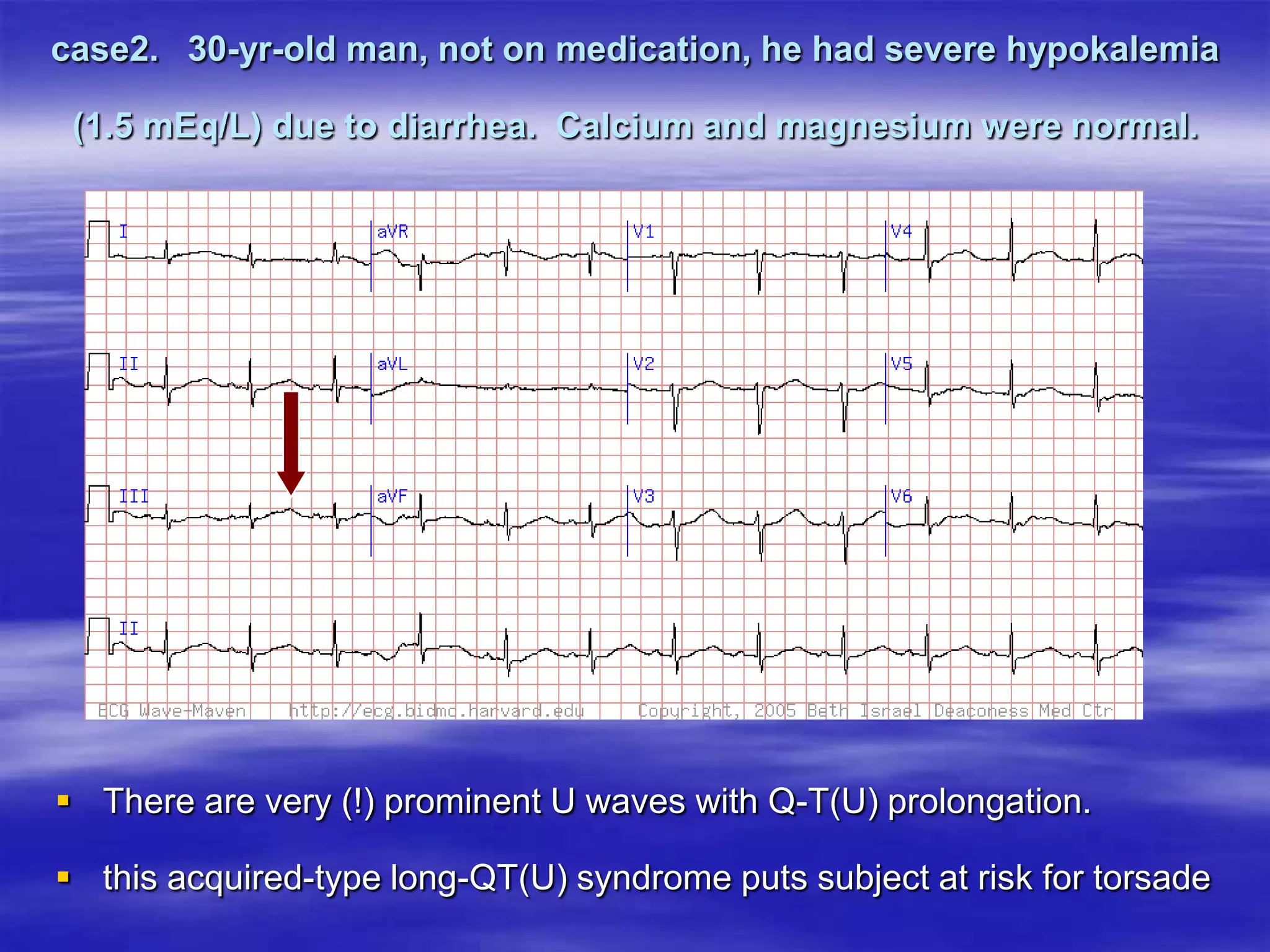 Electrolytes imbalance and ECG changes presentation 2005 | PPTX