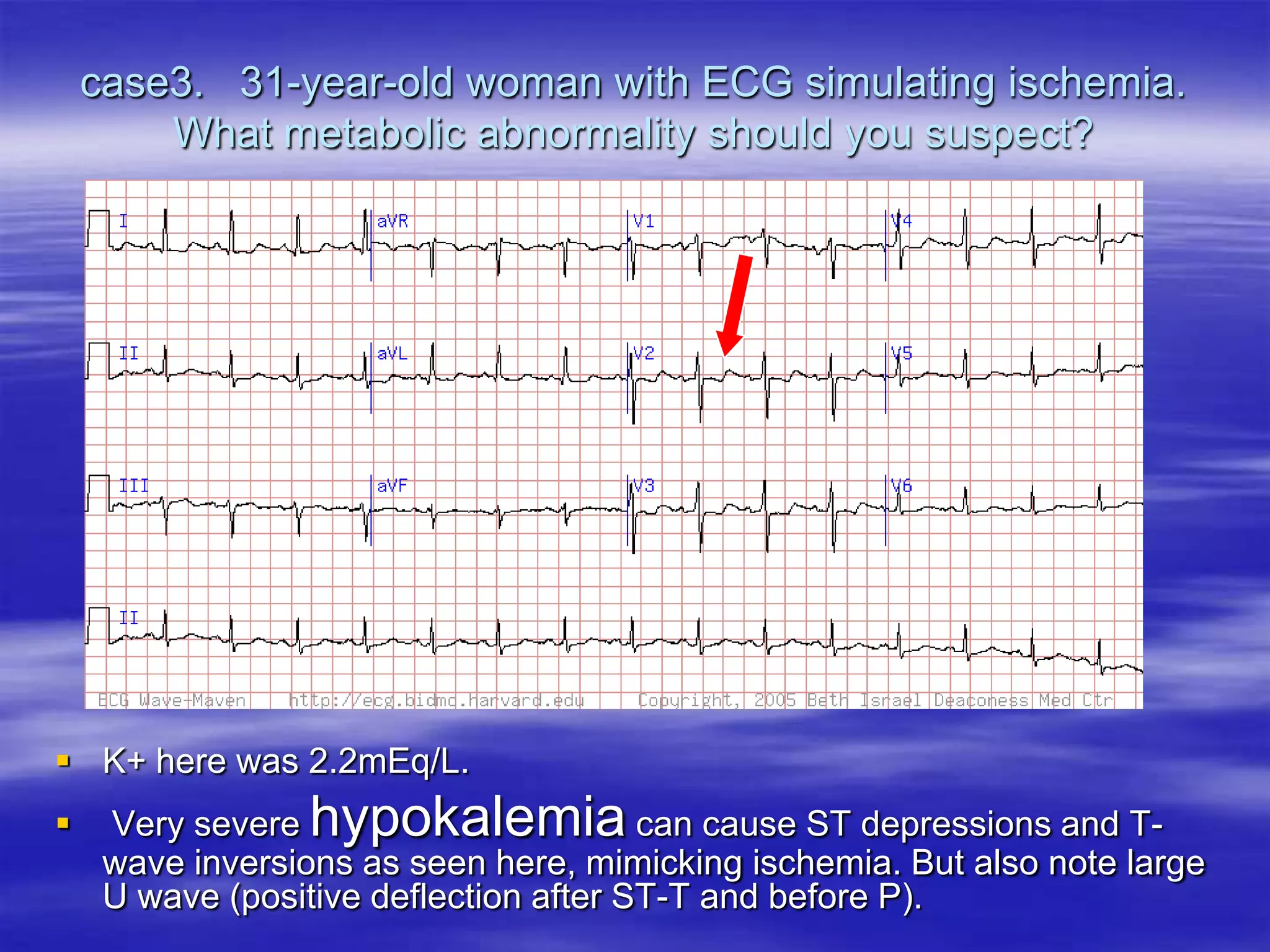 Electrolytes imbalance and ECG changes presentation 2005 | PPTX