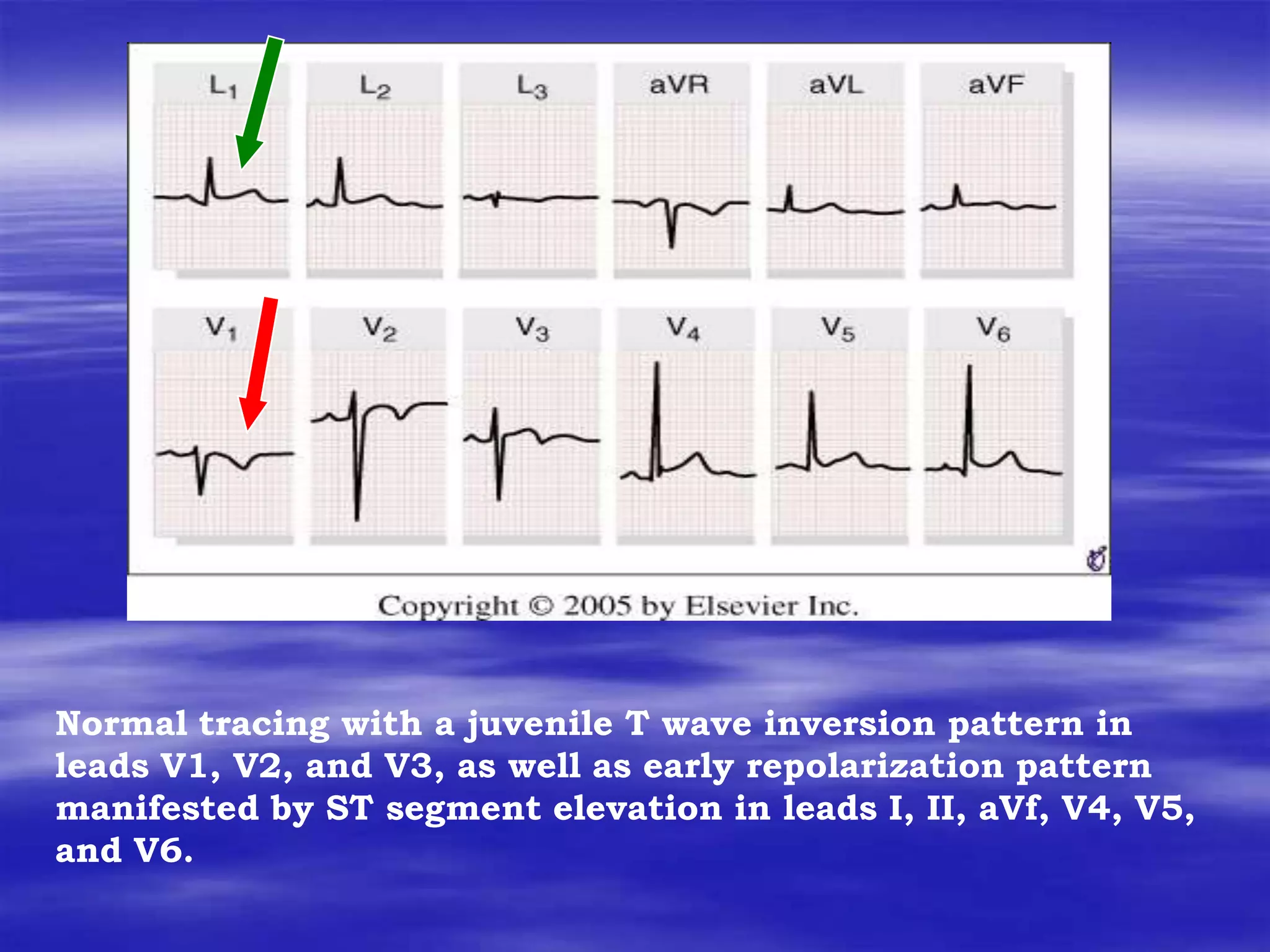 Electrolytes imbalance and ECG changes presentation 2005 | PPTX