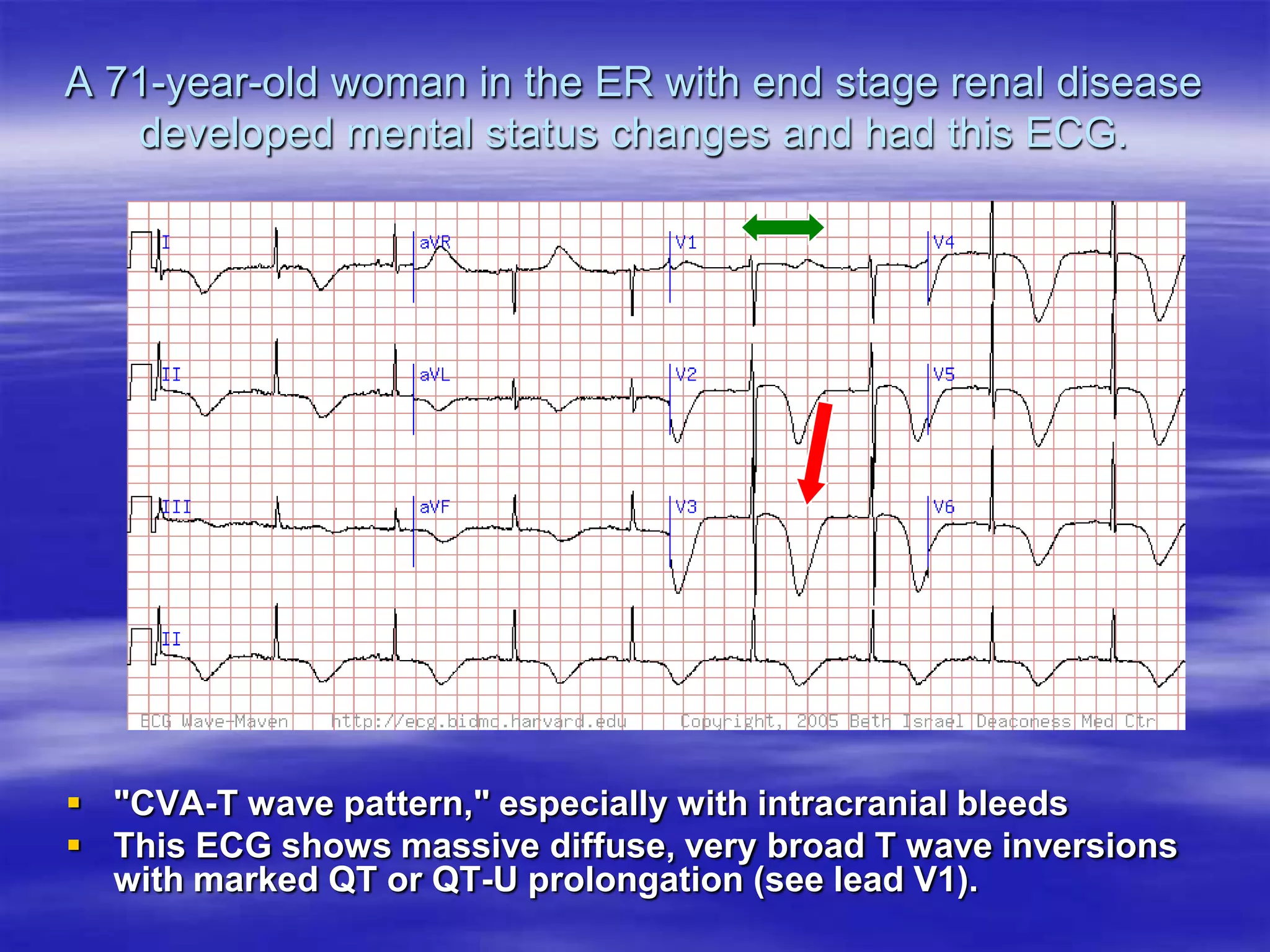 Electrolytes imbalance and ECG changes presentation 2005 | PPTX