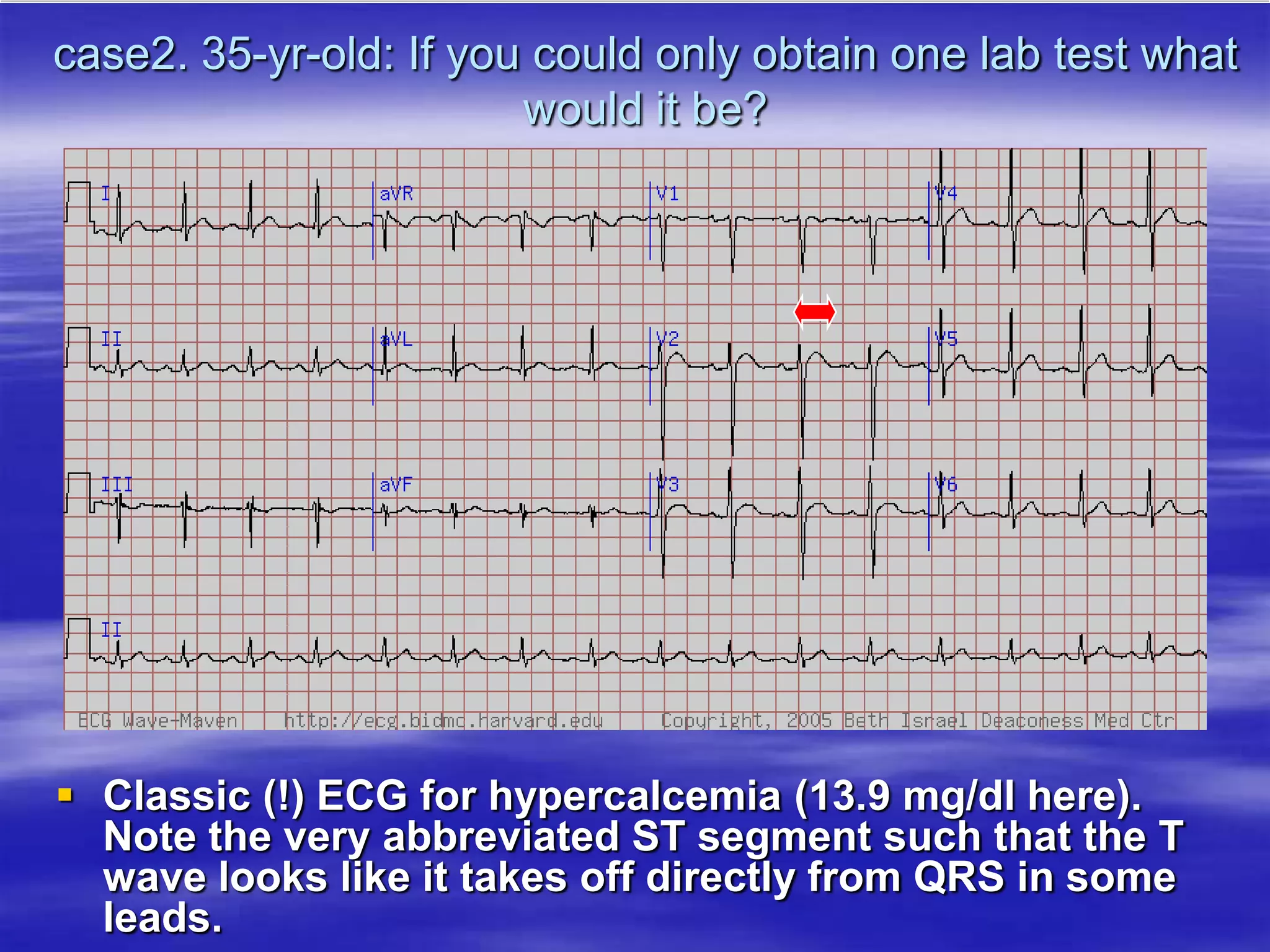 Electrolytes imbalance and ECG changes presentation 2005 | PPTX