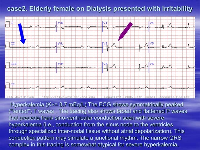 Electrolytes imbalance and ECG changes presentation 2005 | PPTX