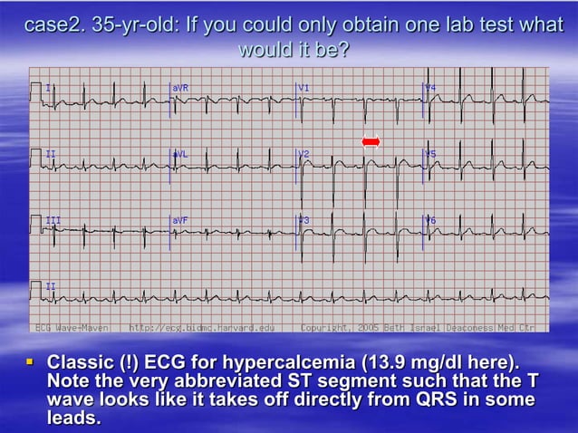 Electrolytes imbalance and ECG changes presentation 2005 | PPTX