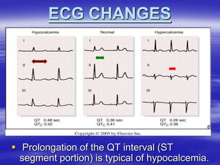 Hypocalcemia Ekg
