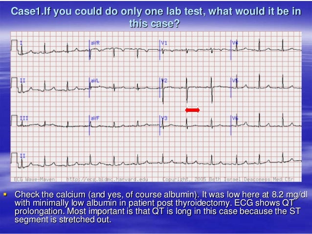 Electrolytes imbalance and ECG changes presentation 2005