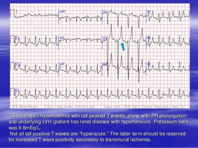 Electrocardiogram Changes With Potassium Imbalance Ecg