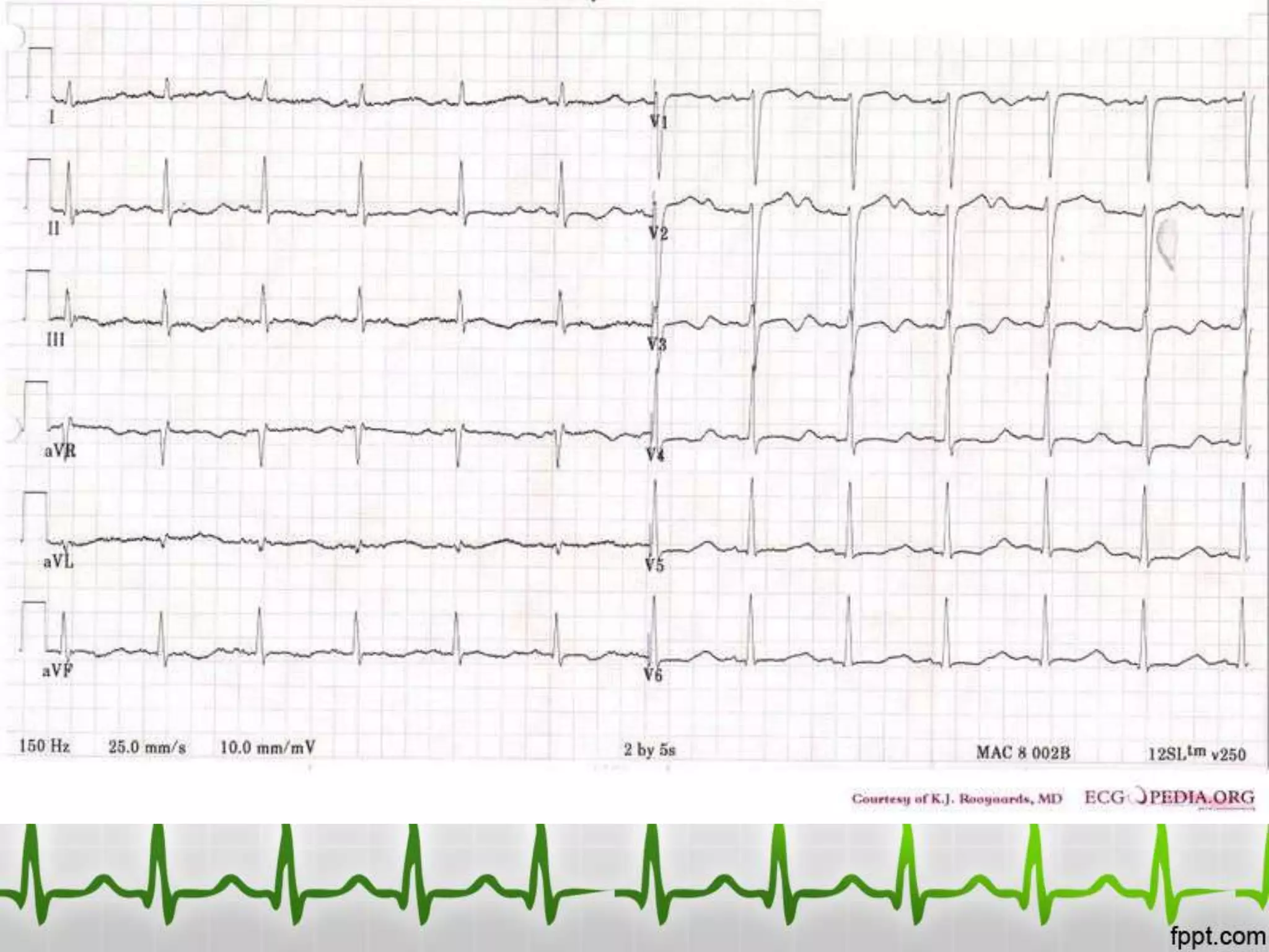 Electrolyte and metabolic ECG abnormalities | PPTX