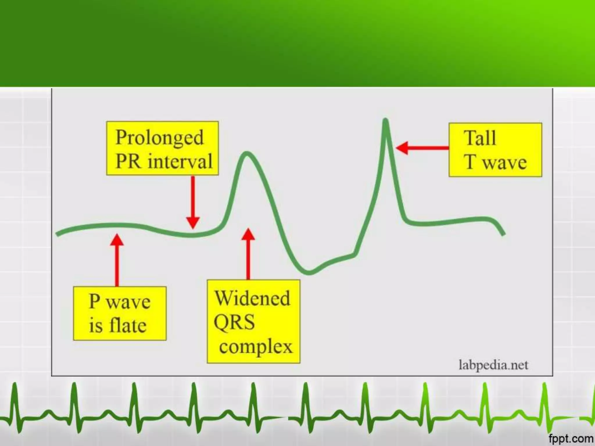 Electrolyte and metabolic ECG abnormalities | PPTX