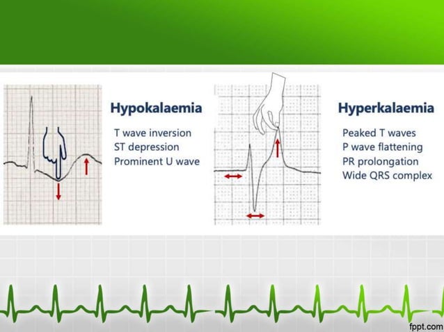 Electrolyte and metabolic ECG abnormalities | PPTX