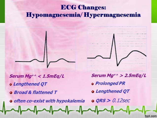 Electrolyte and metabolic ECG abnormalities | PPTX