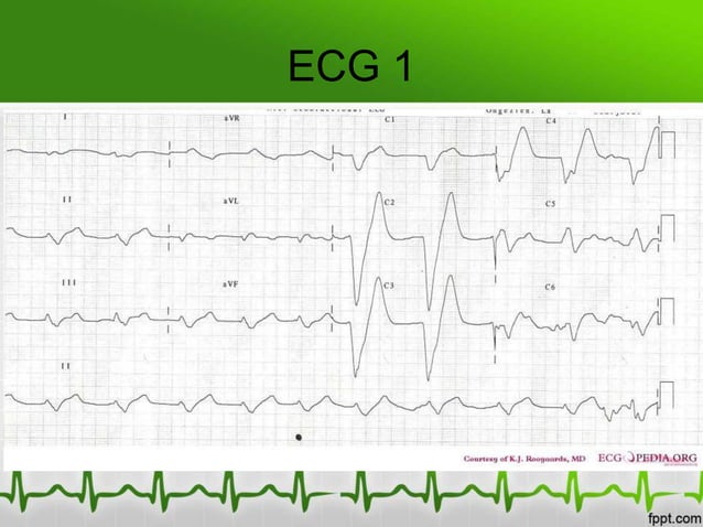 Electrolyte and metabolic ECG abnormalities | PPTX