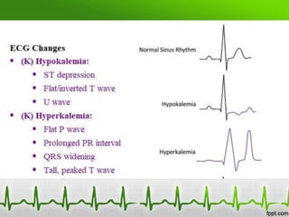 Hypocalcemia Ecg