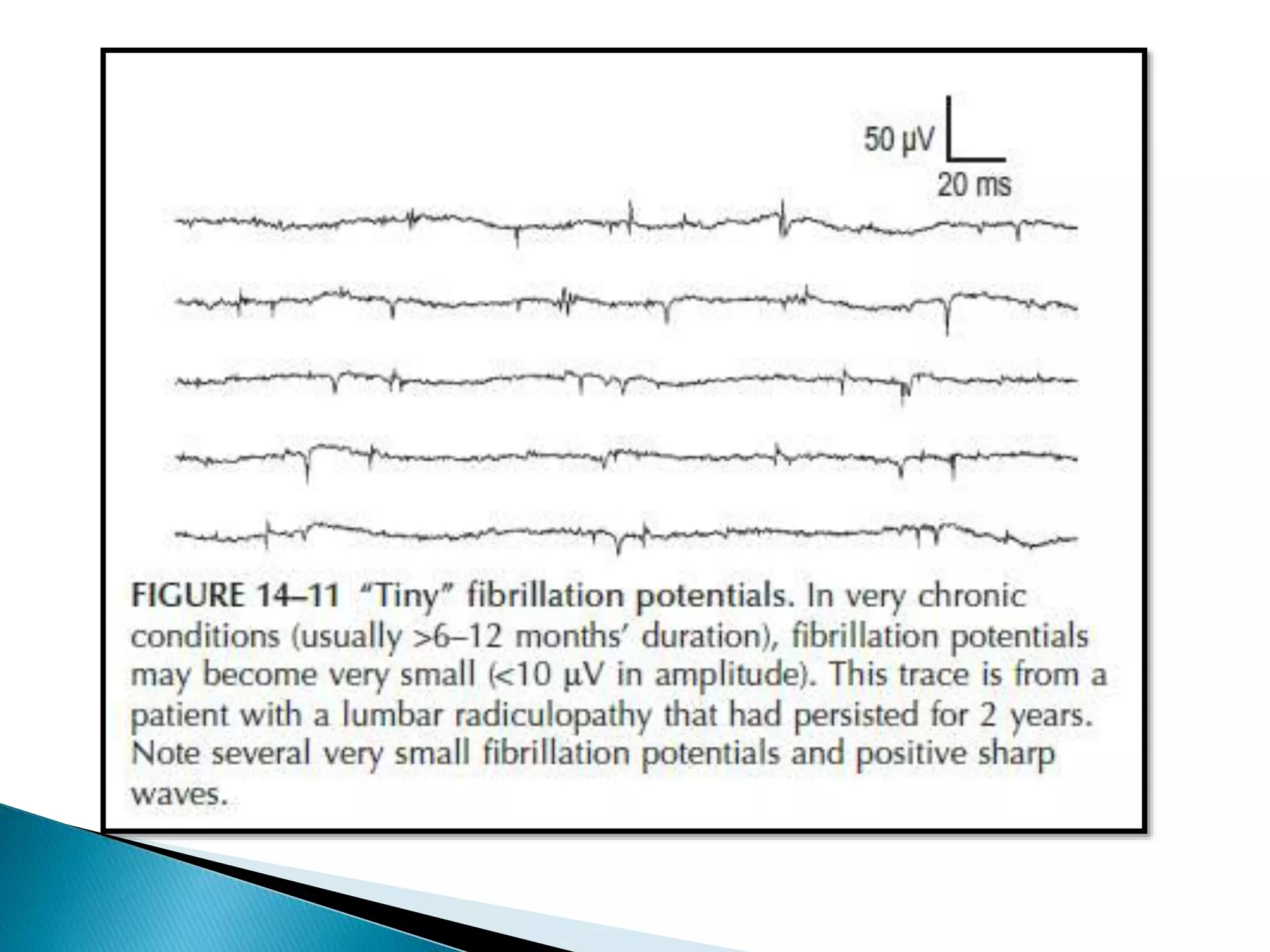 Electromyography (EMG) Basics | PPTX