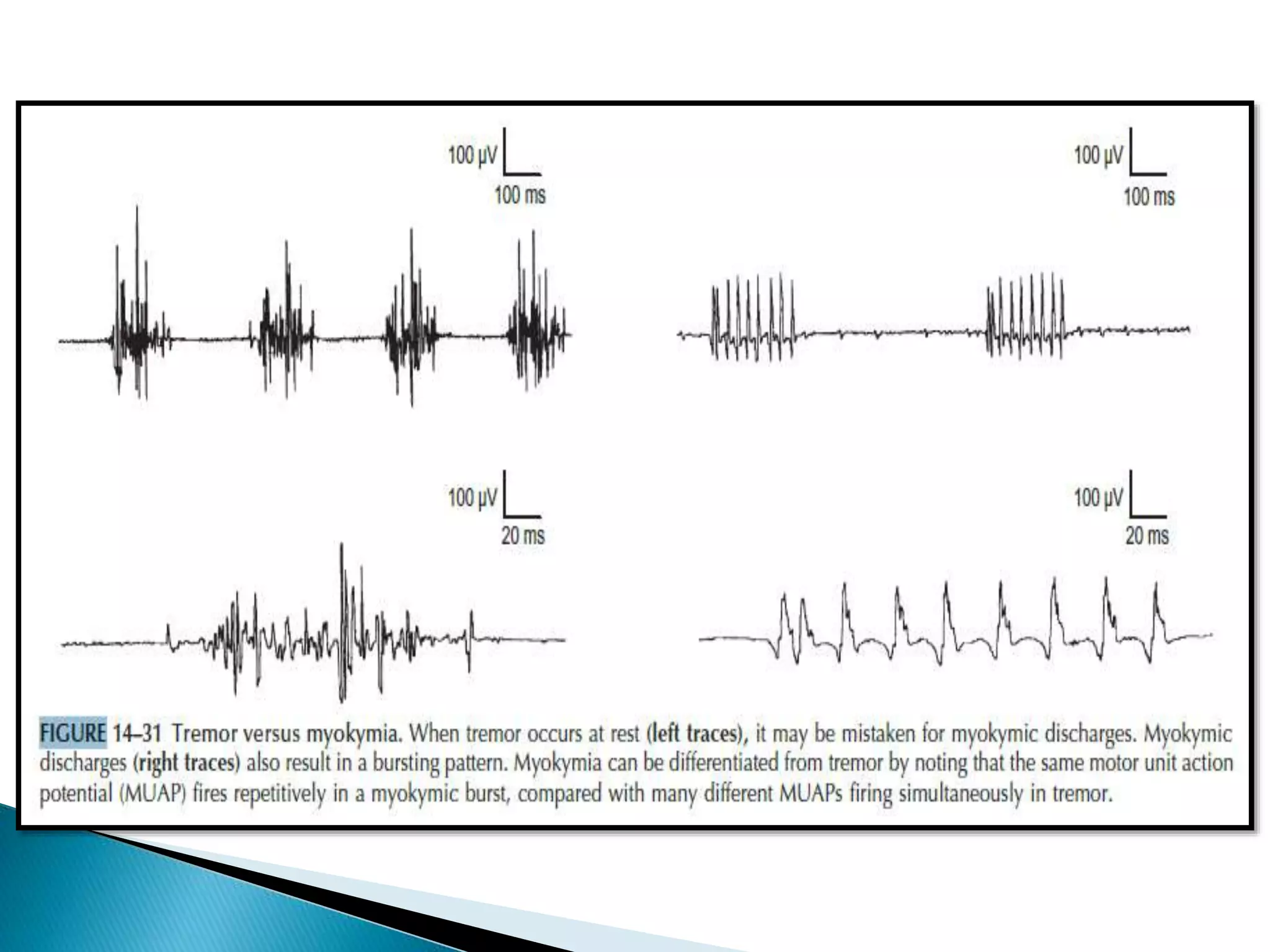 Electromyography (EMG) Basics | PPTX