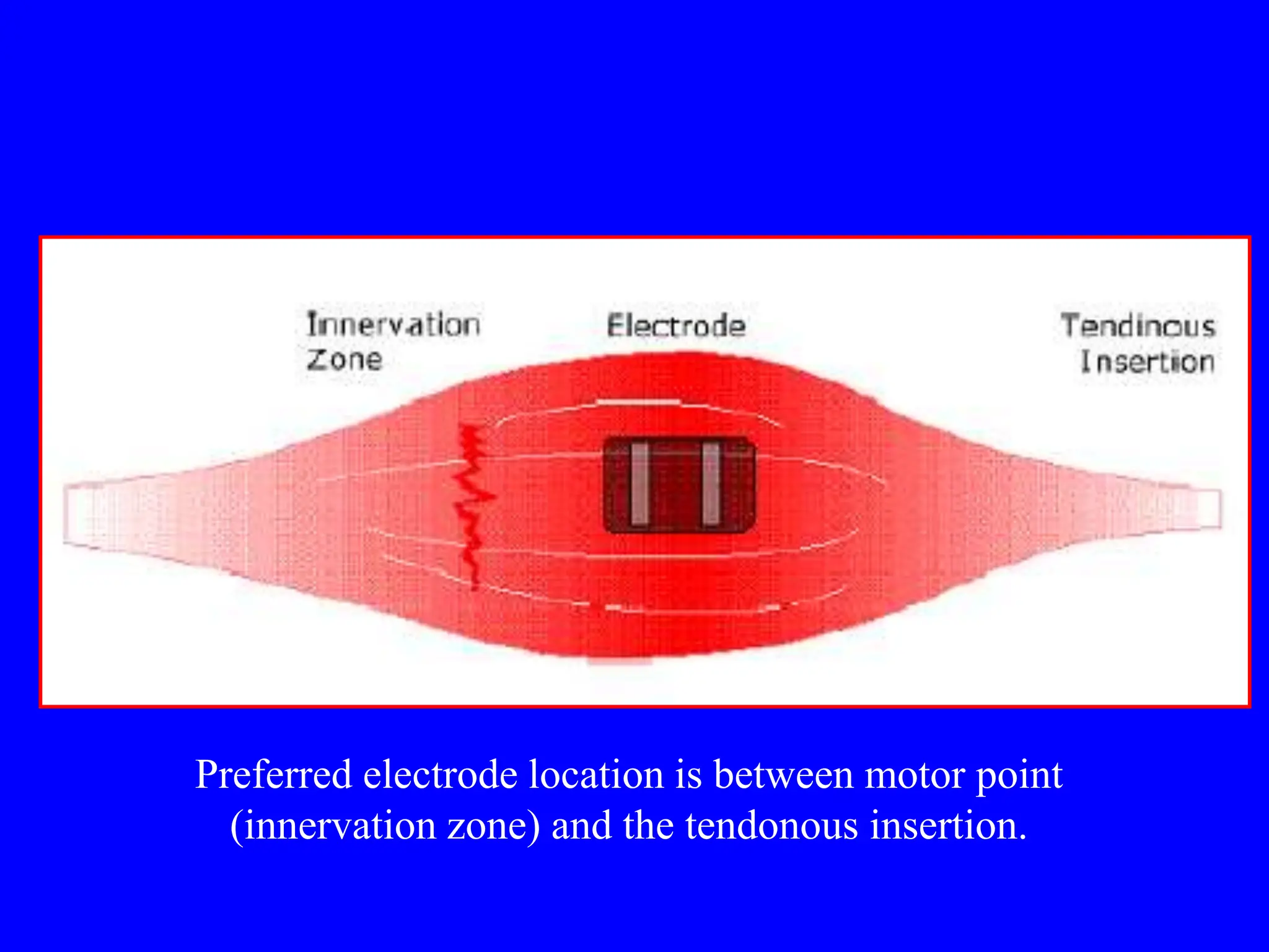 Electromyography and its uses about signals.ppt
