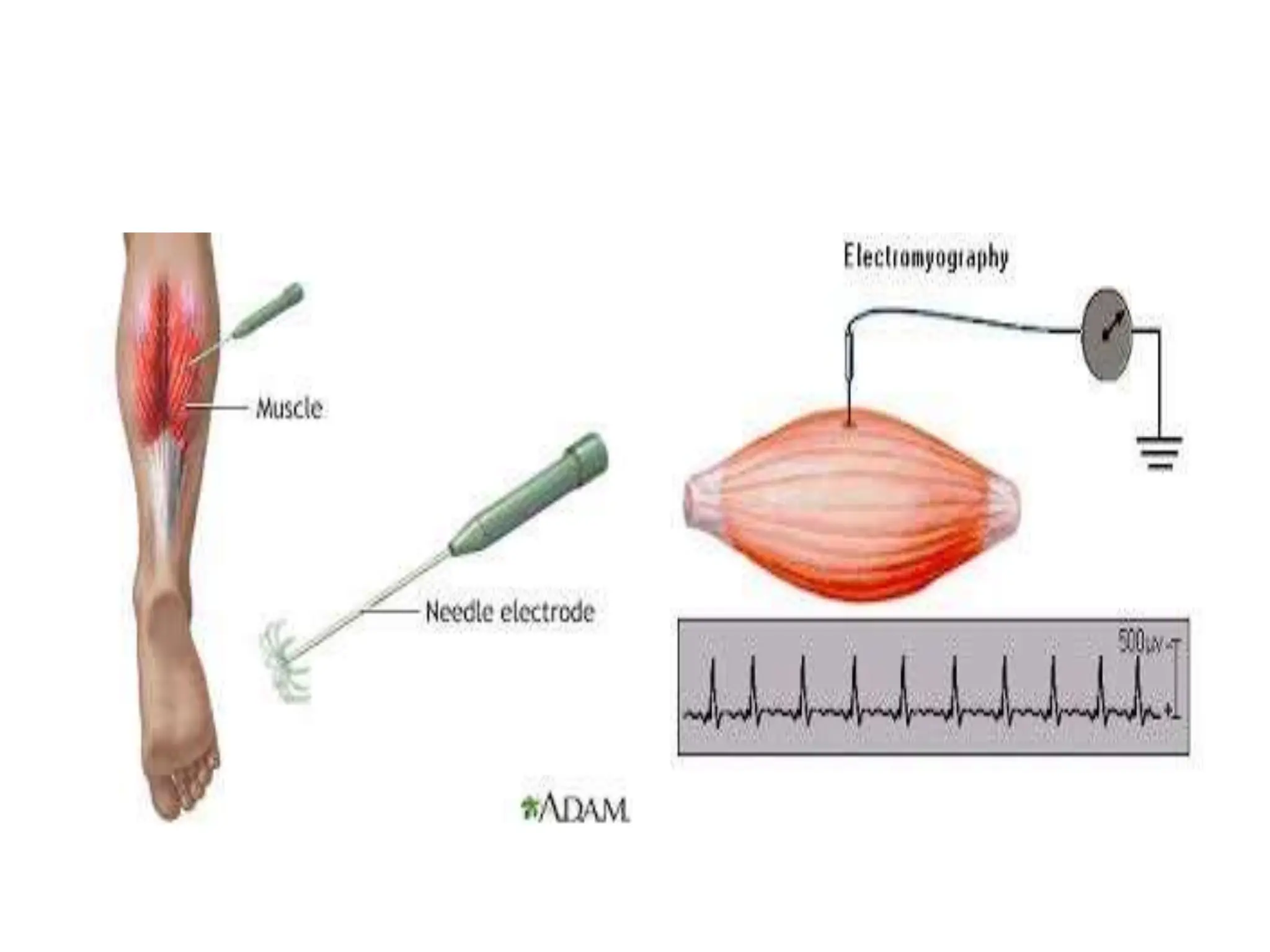 Electromyography.pptx for electrical diagnosed | PPTX | Brain and Nervous System Disorders ...