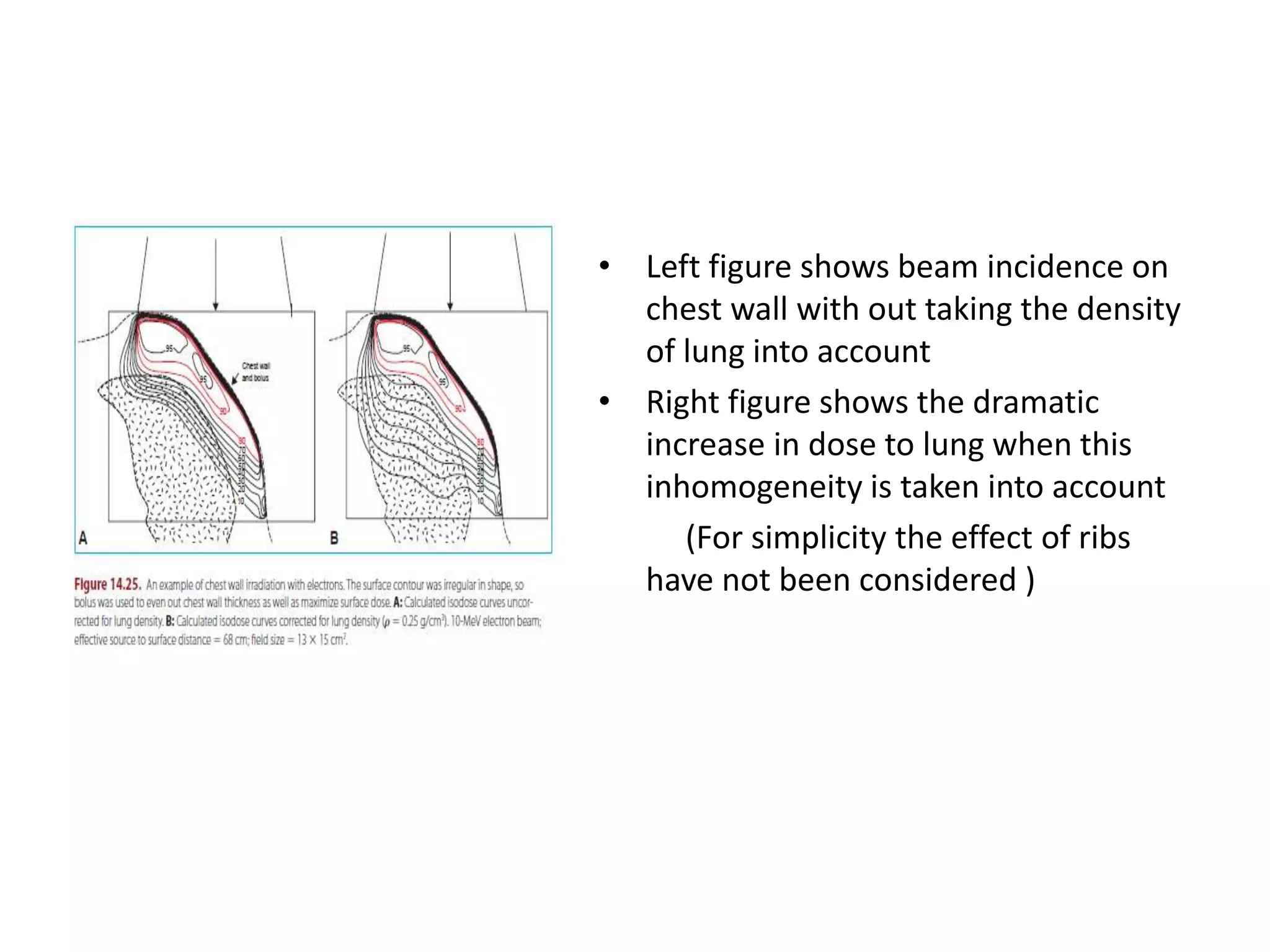 Electron beam therapy | PPTX