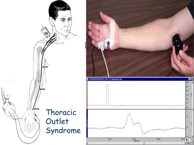 Electroneurography | PPT