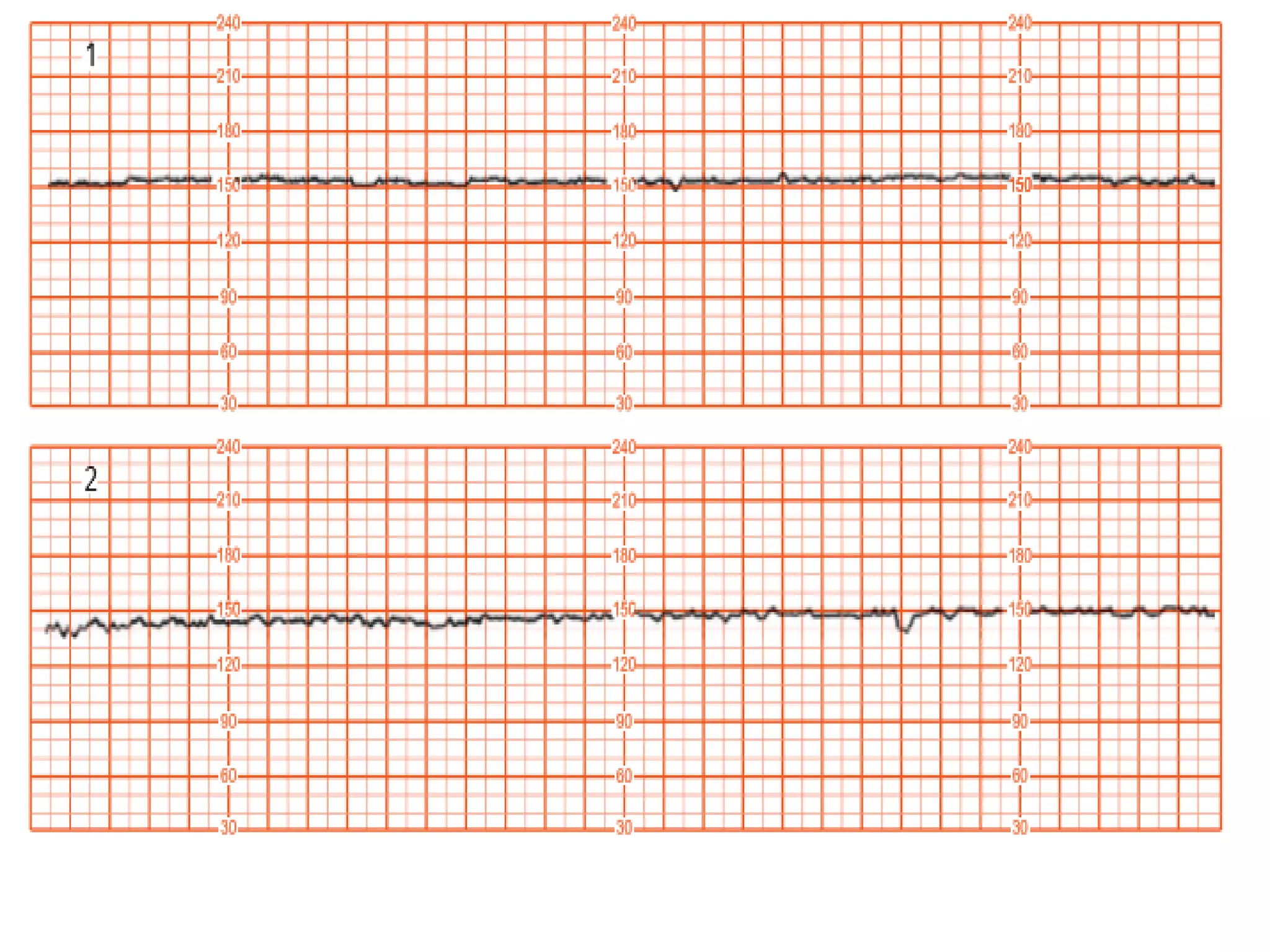 Electronic fetal monitoring | PPTX