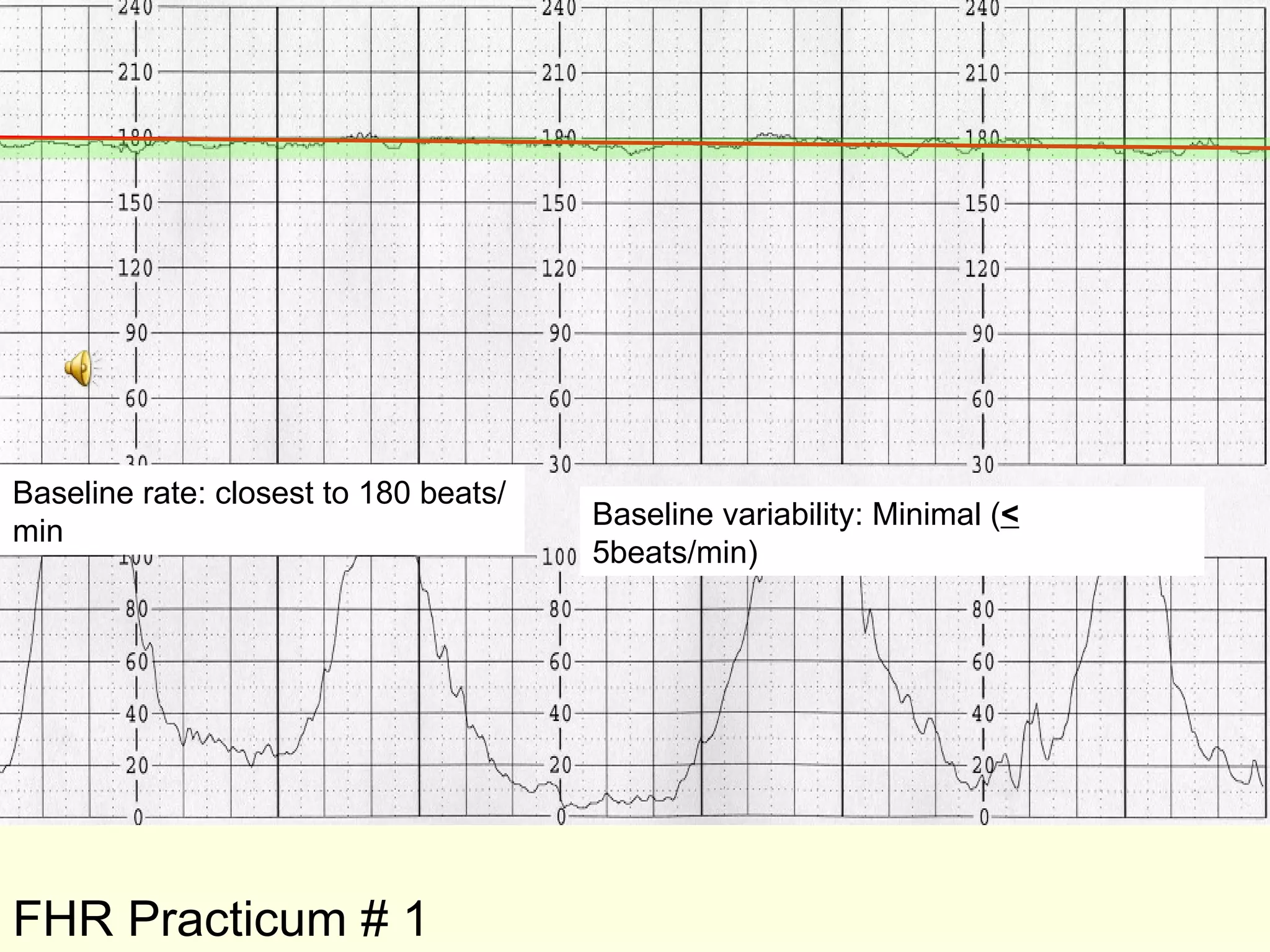 Electronic fetal monitoring. ppt | PPT