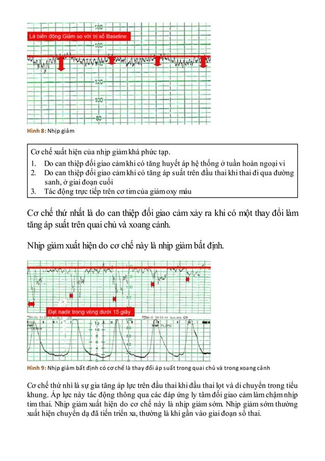 ELECTRONIC FETAL MONITORING ( CTG ) CĂN BẢN TRONG THỰC HÀNH SẢN PHỤ KHOA | PDF