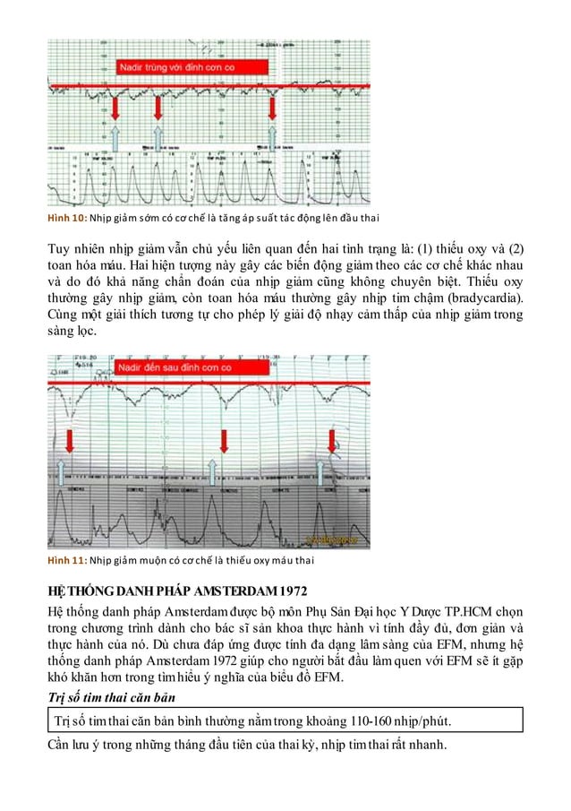 ELECTRONIC FETAL MONITORING ( CTG ) CĂN BẢN TRONG THỰC HÀNH SẢN PHỤ KHOA | PDF