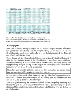 ELECTRONIC FETAL MONITORING ( CTG ) CĂN BẢN TRONG THỰC HÀNH SẢN PHỤ ...