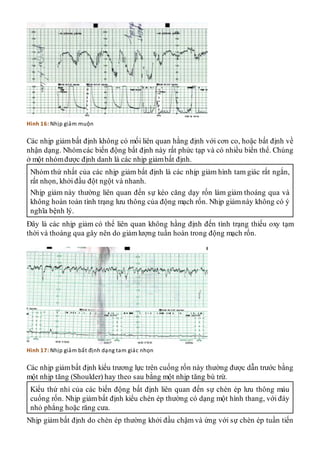 ELECTRONIC FETAL MONITORING ( CTG ) CĂN BẢN TRONG THỰC HÀNH SẢN PHỤ ...