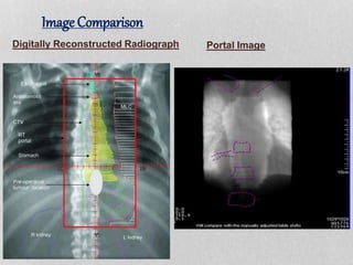 Electronic portal imaging by rose wekesa | PPTX