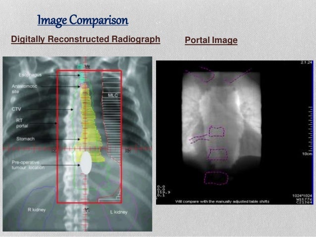 Electronic portal imaging by rose wekesa