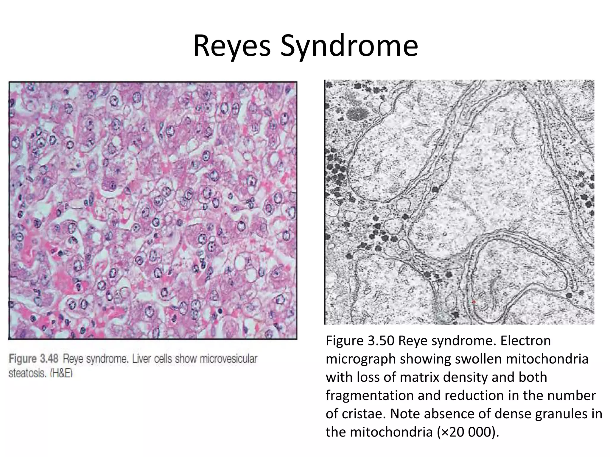 Electron microscopy of liver diseases- 2020 | PPTX