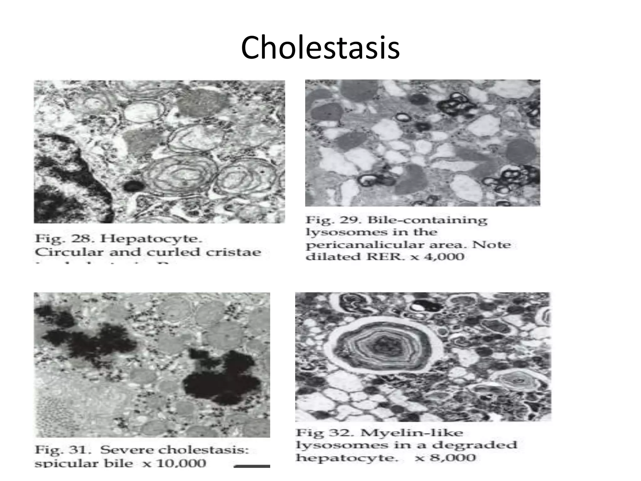 Electron microscopy of liver diseases- 2020 | PPTX