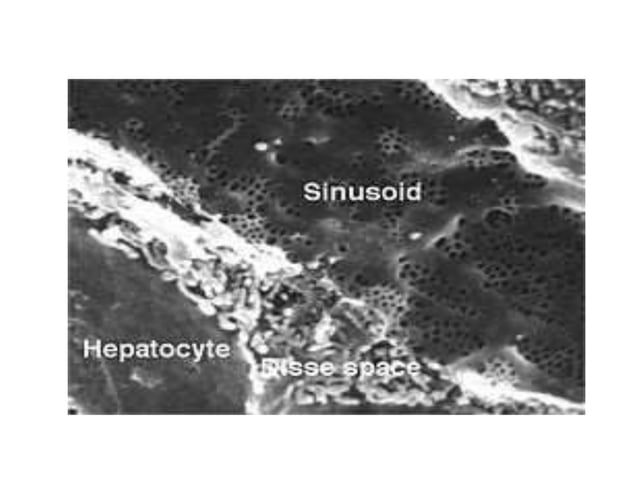 Electron microscopy of liver diseases- 2020 | PPTX | Blood Disorders ...