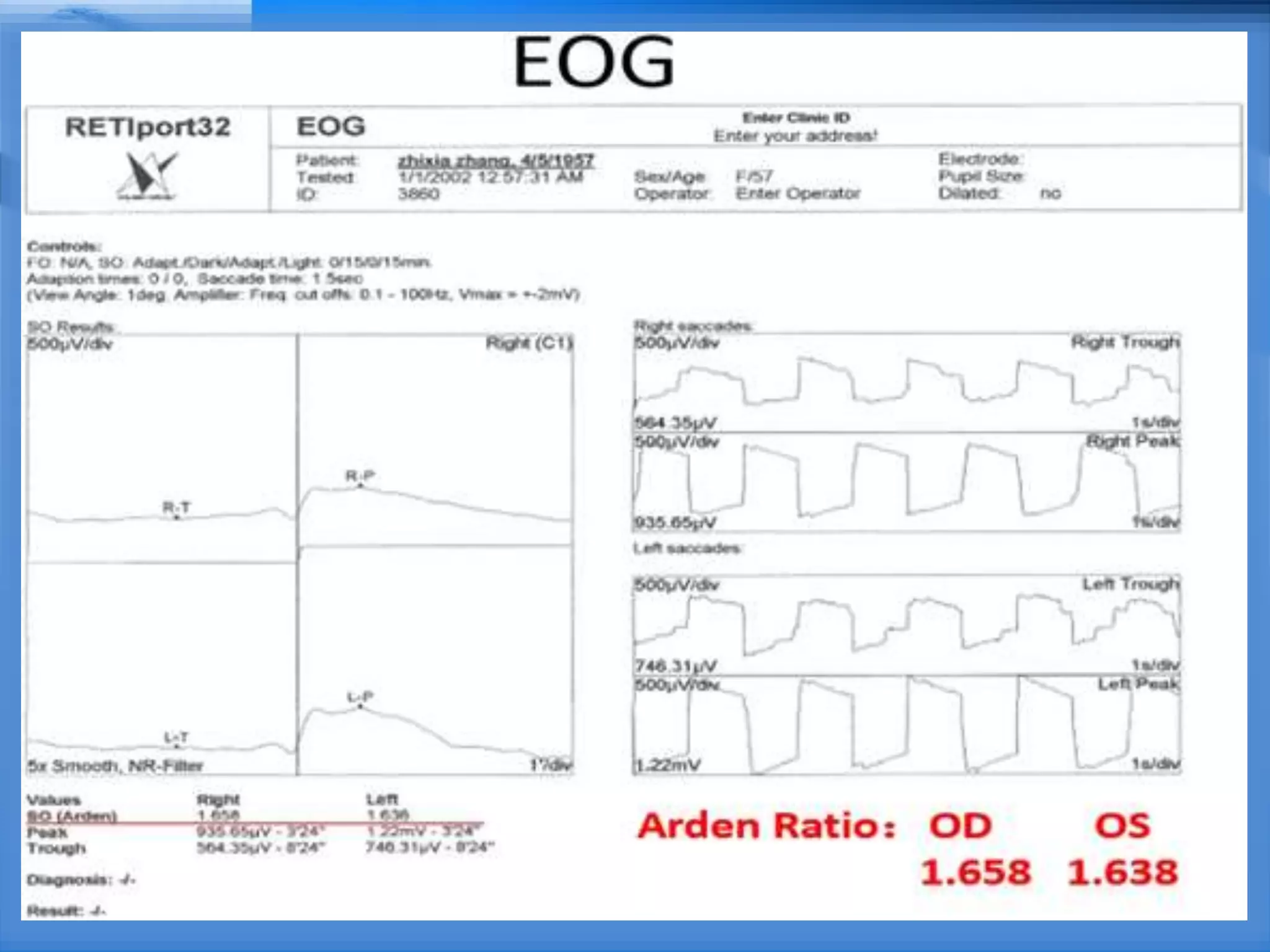 Electrooculogram- EOG | PPSX