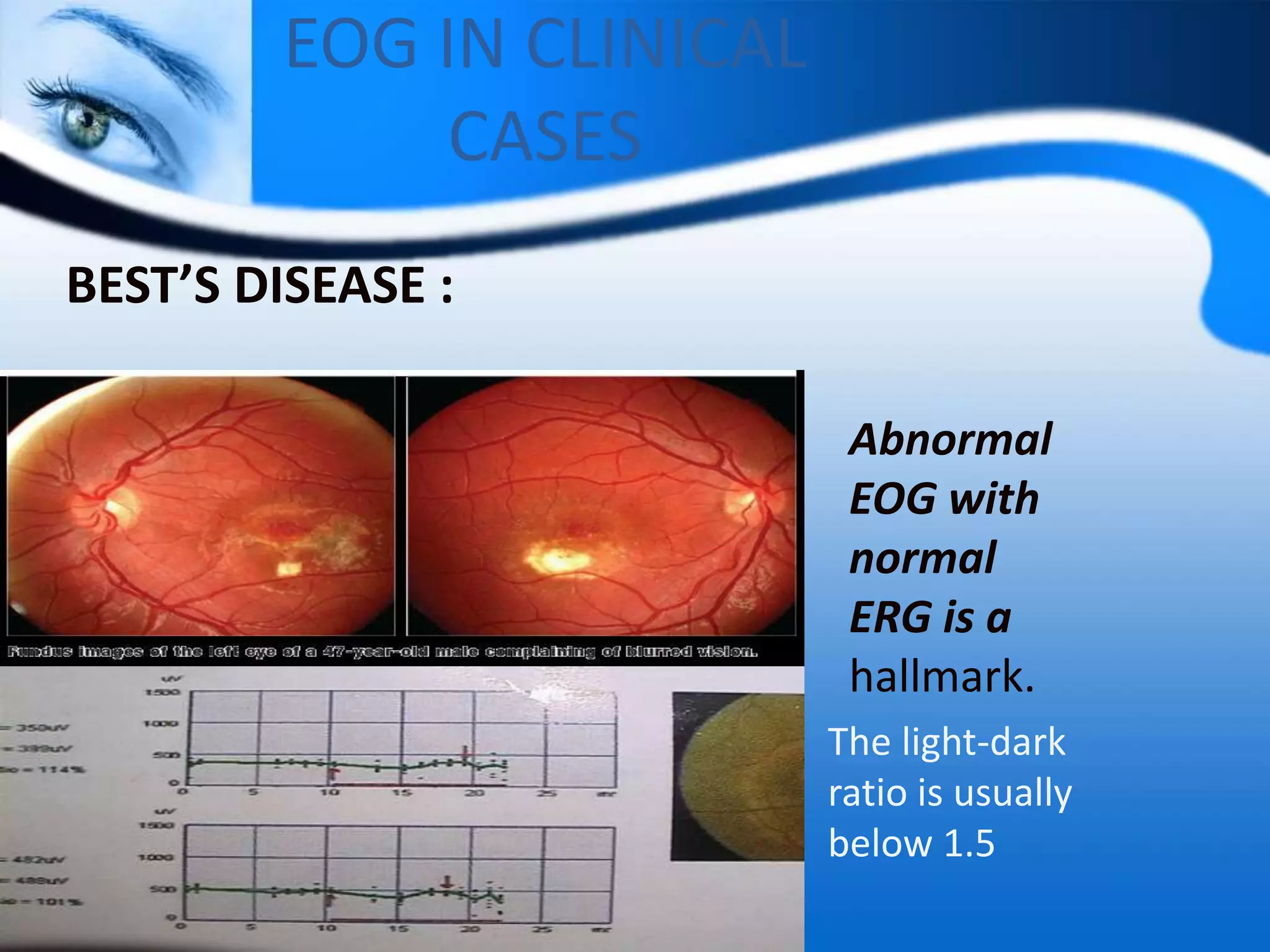 Electrooculogram- EOG | PPSX