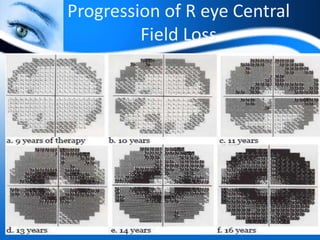 Electrooculogram- EOG | PPSX