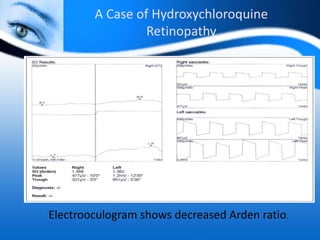Electrooculogram- EOG | PPSX