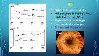 Electrophysiological Tests - ERG, EOG, VEP in ophthalmology.pptx