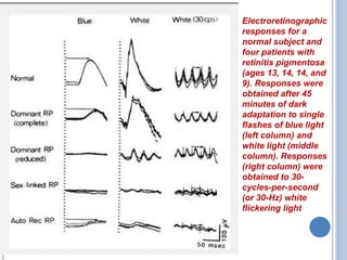 Electrophysiology in retinitis pigmentosa | PPTX