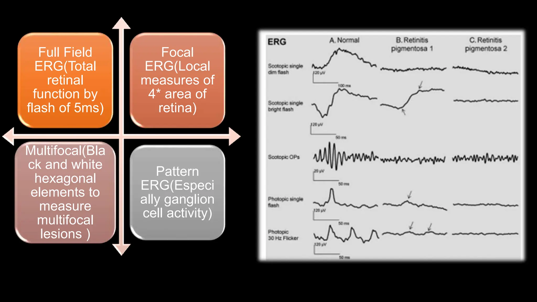 Electrophysiology (Electro-retinogram,Electro-oculogram, Visual evoked ...
