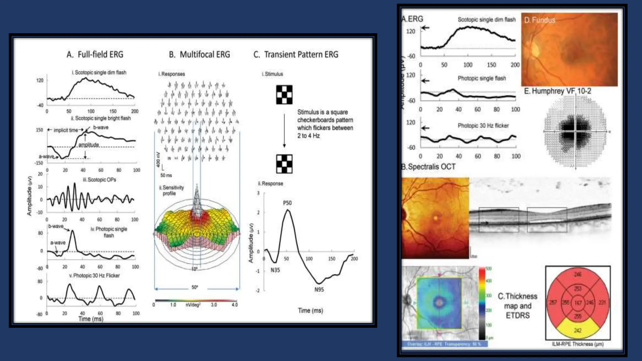 Electrophysiology (Electro-retinogram,Electro-oculogram, Visual evoked ...