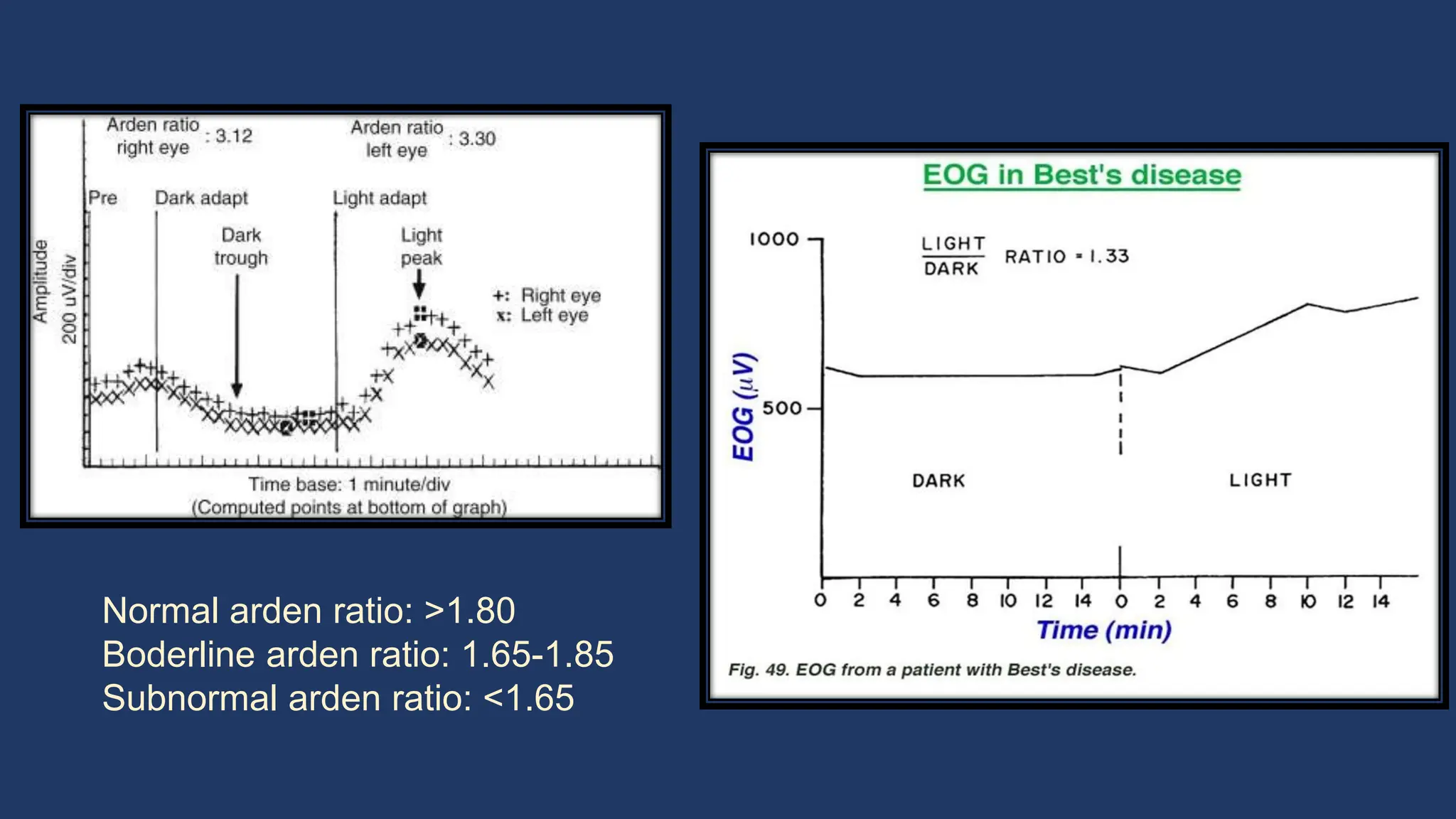 Electrophysiology (Electro-retinogram,Electro-oculogram, Visual evoked ...