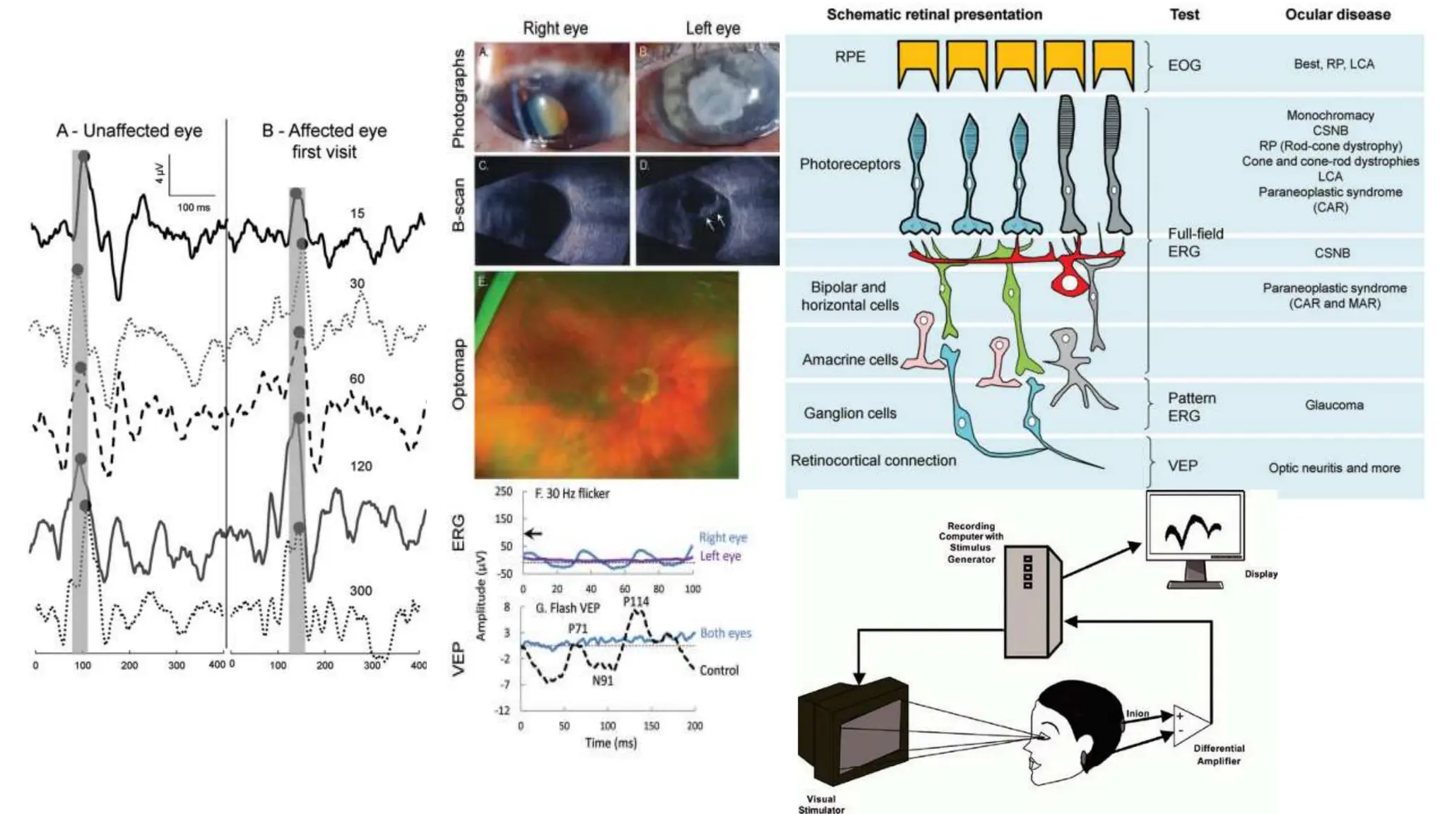 Electrophysiology (Electro-retinogram,Electro-oculogram, Visual evoked potential) | PPTX
