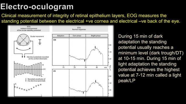 Electrophysiology (Electro-retinogram,Electro-oculogram, Visual evoked ...