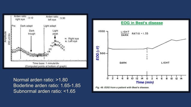 Electrophysiology (Electro-retinogram,Electro-oculogram, Visual evoked ...