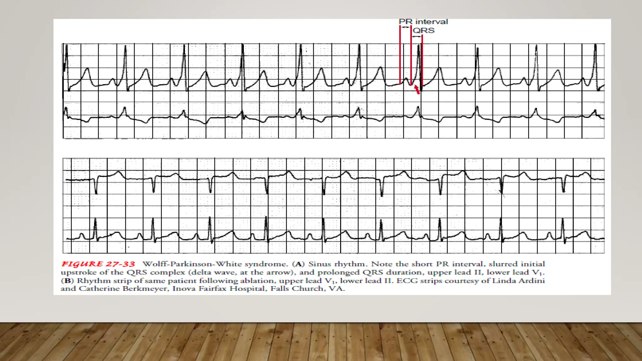 Electrophysiology study and Cardiac Ablation (4).pptx