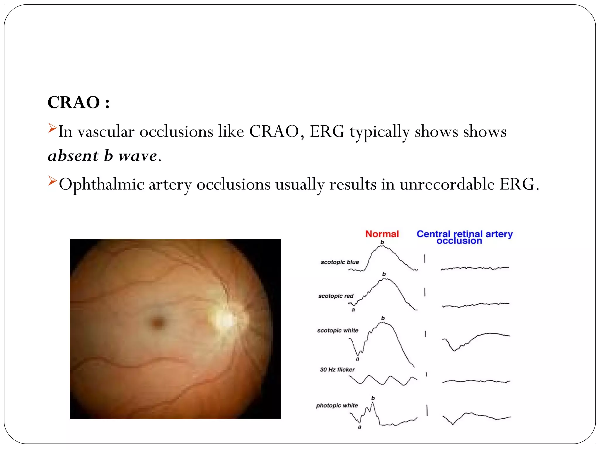 Electrophysiology in Ophthalmology | PPT